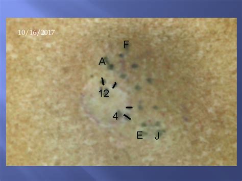Chasing Margins Of Melanoma In Situ Of Back Skin Cancer And