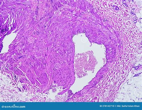 Prepatellar Region Histology Showing Bursitis Acute Or Chronic