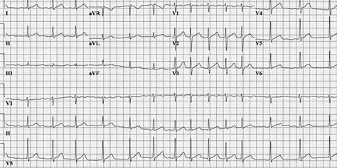 Rate And Rhythm Control Similar In Atrial Fibrillation After Cardiac