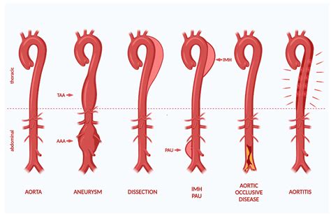 Inflammasomes In The Pathophysiology Of Aortic Disease
