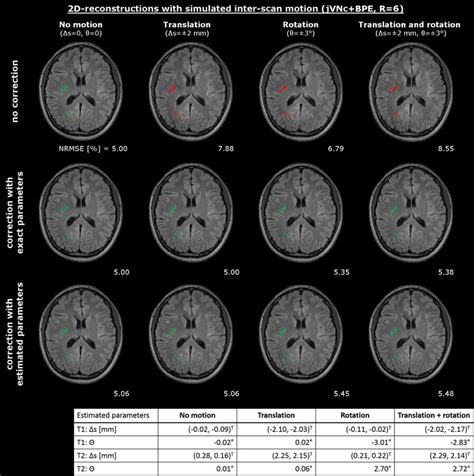 Motion Artifacts Cause At Jerome Henderson Blog