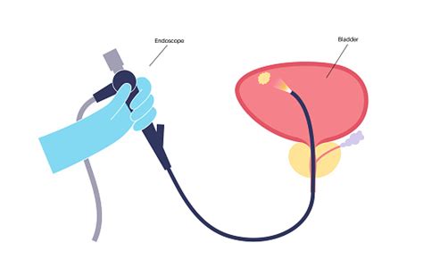 Konsep Pemeriksaan Cystoscopy Ilustrasi Stok Unduh Gambar Sekarang