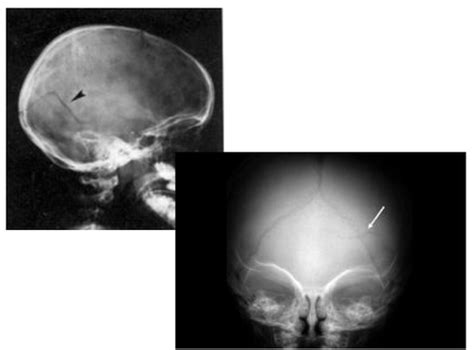 Skull Flashcards Quizlet