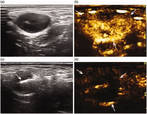A 23 Year Old Female Patient With Cervical Tuberculous Lymphadenitis