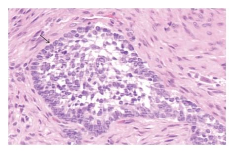 A Predominant Spindle Cell Pattern See Arrow Hande B Basaloid Download Scientific Diagram