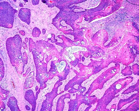 Squamous Cell Carcinoma Of The Larynx Light Micrograph Stock Image