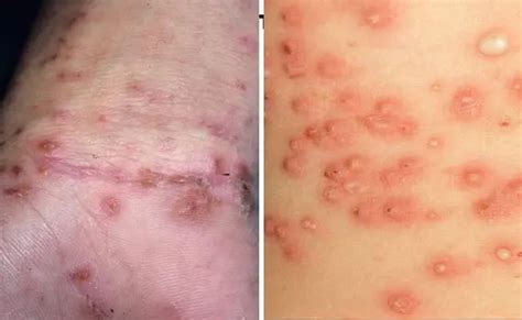 Scabies Types Symptoms Causes And Treatment Healthy Food Near Me