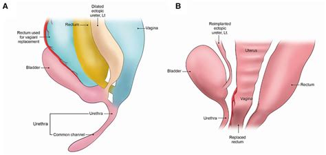 Selection Of Laparoscopic Assisted Us With Vaginal Replacement As The