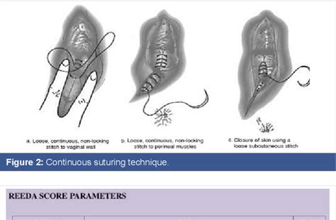 Lock Stitch Suture