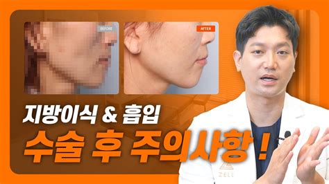 지방이식 And 지방흡입 주의사항 지방흡입 수술 후 샤워는 어떻게 하나요 🤔 Eng Jp Sub Youtube
