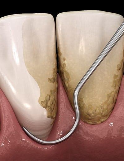 Scaling Root Planing North Dallas Gum Disease Treatment Dental Attraction