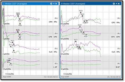Intraoperative Neurophysiological Monitoring Ionm During Peripheral