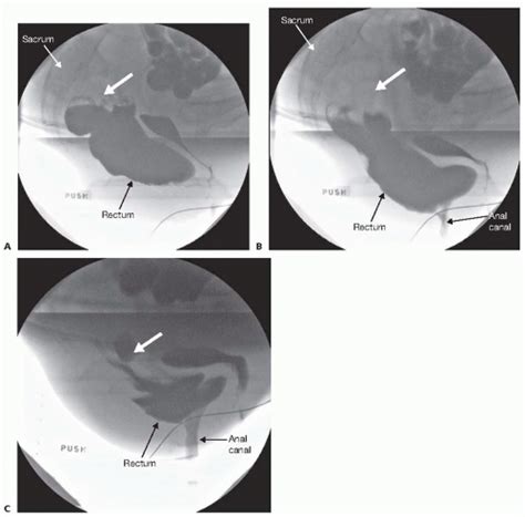 Sigmoid Colectomy Laparoscopic Technique Basicmedical Key