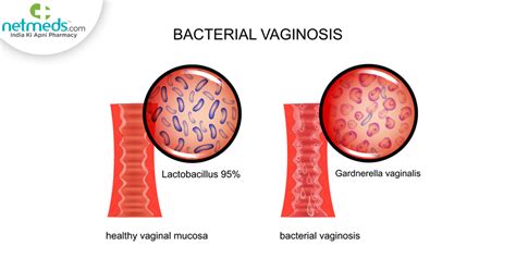 Bacterial Vaginosis Causes Symptoms And Treatment