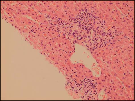 Mild Predominantly Lobular Lymphohistiocytic And Lymphoplasmacytic Download Scientific Diagram