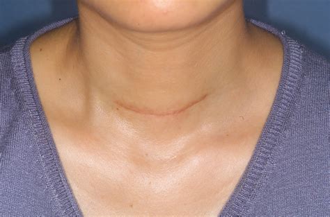 Thyroid Removal Surgery Scar At Nancy Colon Blog