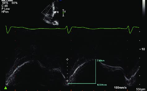 Assessment Of Right Ventricular Systolic Function By Tricuspid Annular Download Scientific