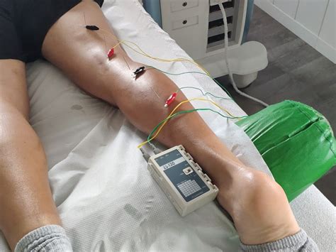 NeuromodulaciÓn PercutÁnea Nmp Impulsa Fisioterapia