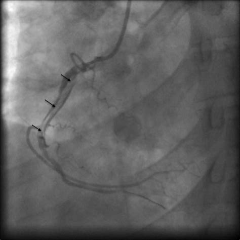 Angiographic Image Of Right Coronary Artery Demonstrating Diffuse Download Scientific Diagram