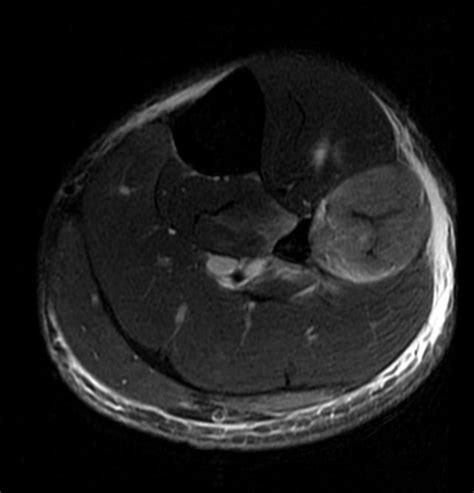 Compartment Syndrome Of The Leg Radsource