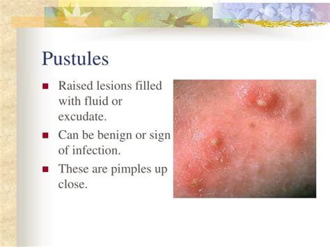 Ppt Rashes And The School Nurse Powerpoint Presentation Id 2777002