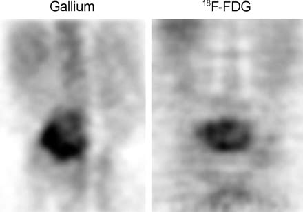 Radionuclide Imaging Of Infection Journal Of Nuclear Medicine Technology