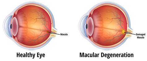 What Is Macular Degeneration Precision Eye Care Md