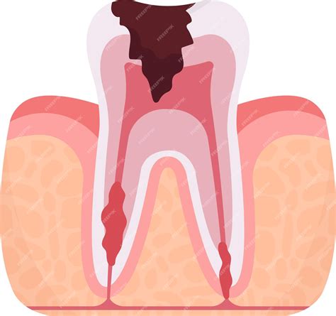 Premium Vector Periodontitis Tooth Problem