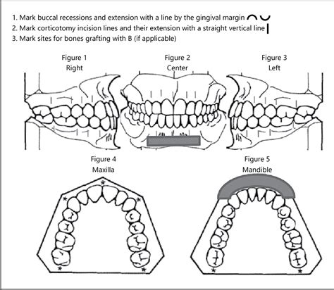 Orthodontic Tooth Chart Ponasa