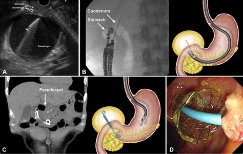Inadvertent Double Puncture Of The Stomach And Duodenum During Eus Guided Pseudocyst Drainage