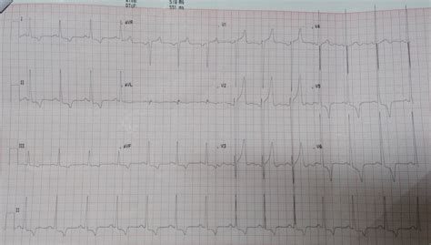 Cardiology Window Left Ventricular Hypertrophy With Lv Strain Pattern