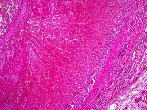 004a Organizing Thrombus
