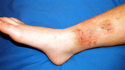 Poison Sumac Rash Length At Lucy Gardiner Blog