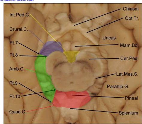 Figure 1 From Microsurgical Approaches To The Ambient Cistern Region