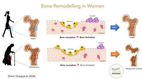 New Research The Effect Of Inflammation On Your Bone Health In