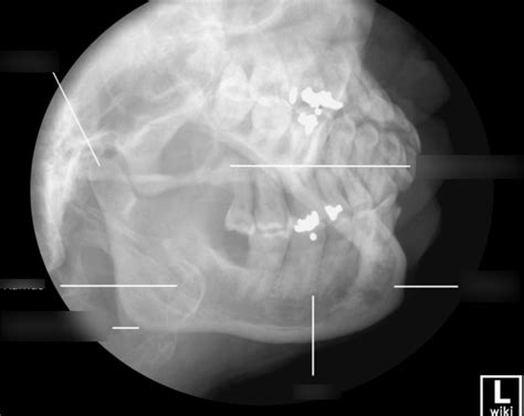 Mandible Diagram Quizlet