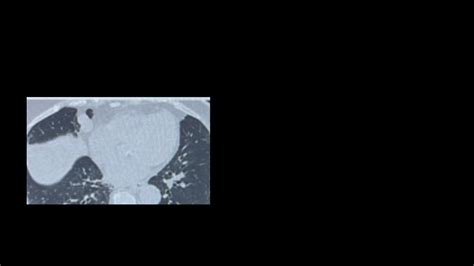 Giuseppe La Mattina On Linkedin 20 Mm Hypermetabolic Nodule Suvmax 3 9 Ultrathin With 1 2 Mm