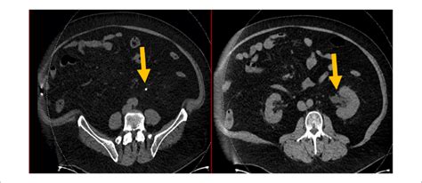 Computed Tomography Stone Showed A 7 Mm Left Mid Ureteral Calculus