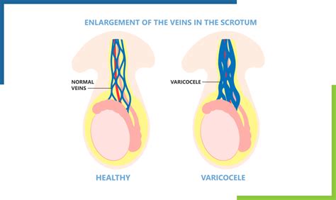 Varicocele Embolisation Lumina Interventional Radiology