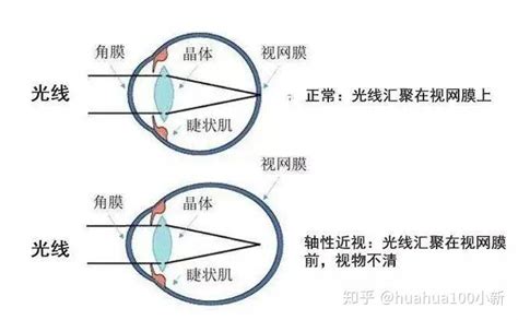 近视和老花眼能抵消吗 知乎