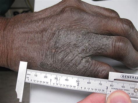 Neurodermatitis Lichen Simplex Chronicus Chronic Scratch Rash Healthhype