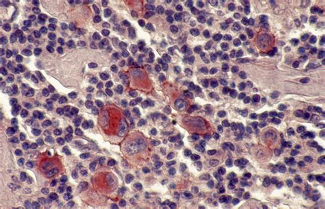 Hodgkins Lymphoma In Lymph Node Light Micrograph Stock Image C060