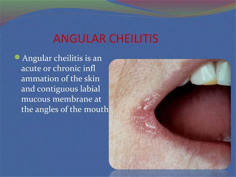 Cheilitis Ppt