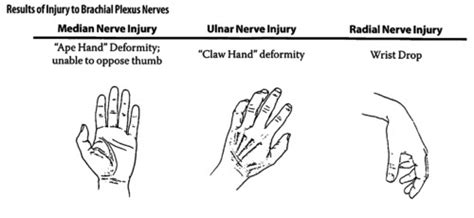 Nerve Injuries Positioning Pp Flashcards Quizlet
