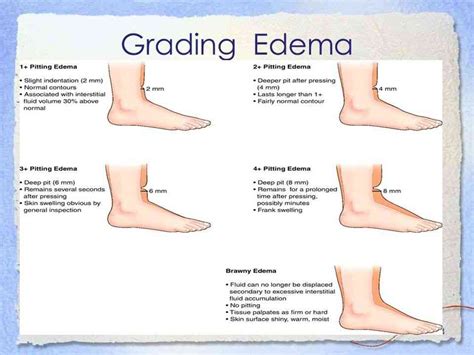 Leg Edema Classification At Thomas Butterfield Blog