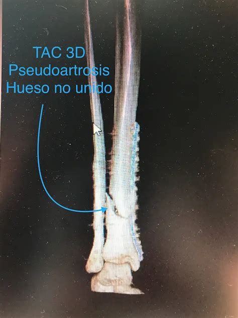 Pseudoartrosis De Tibia Utcvitoria