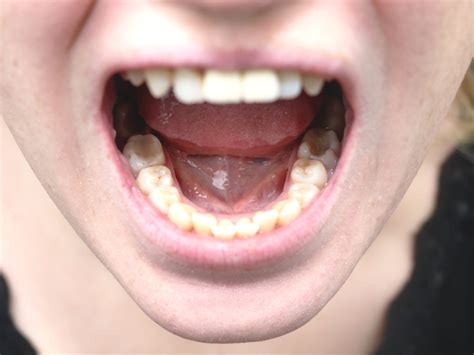 Mouth Cancer Prevention Tips And Warning Signs Bloogao