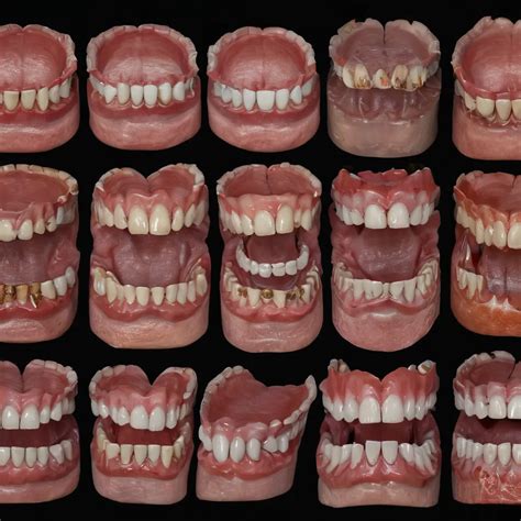 Exploring Partial Denture Materials For Optimal Care