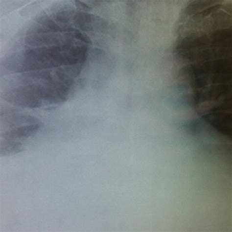 Native Lung Rtg On One Year After Surgery Download Scientific Diagram