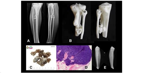 A Pre Operative X Ray Of Proximal Tibial Exostosis B Real Size 3d